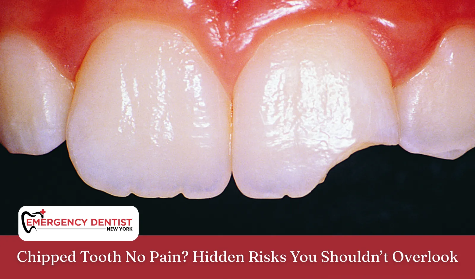 Chipped Tooth No Pain? Hidden Risks You Shouldn’t Overlook
