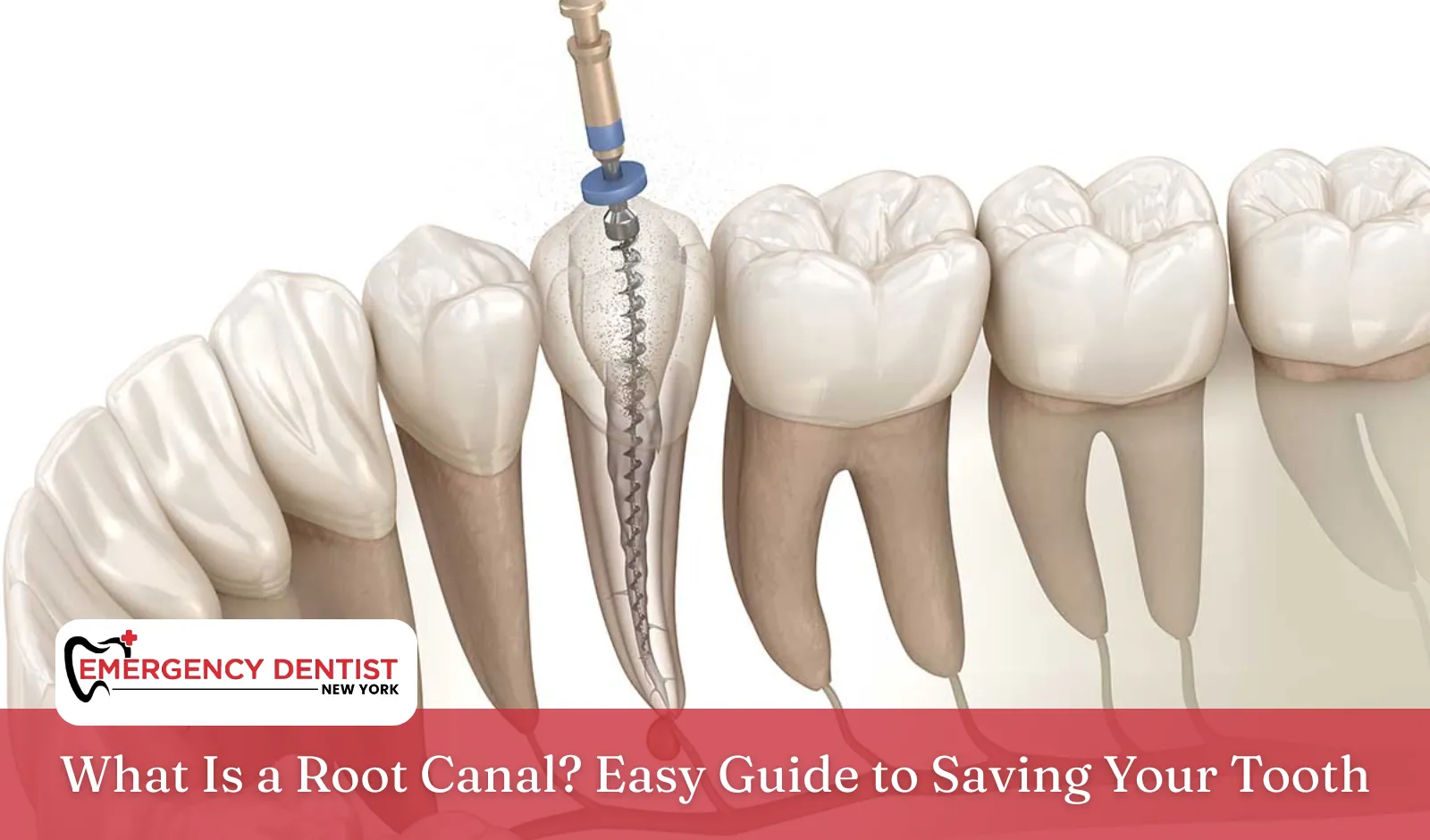 What Is a Root Canal? Easy Guide to Saving Your Tooth